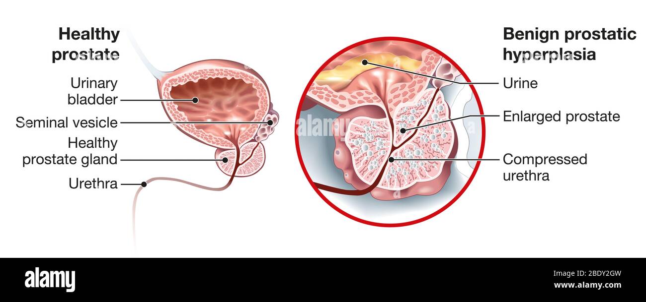 Illustration Showing Healthy Prostate And Benign Prostatic Hyperplasia