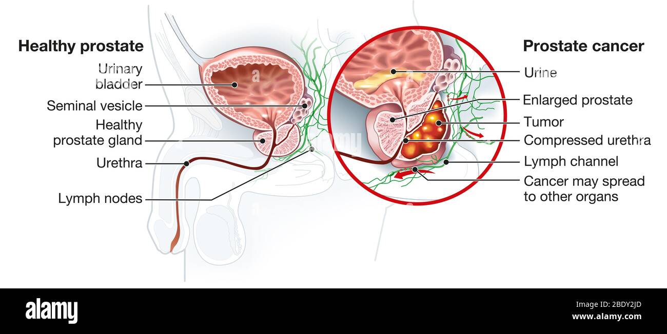 Medically Illustration Showing Healthy Prostate Gland And Prostate