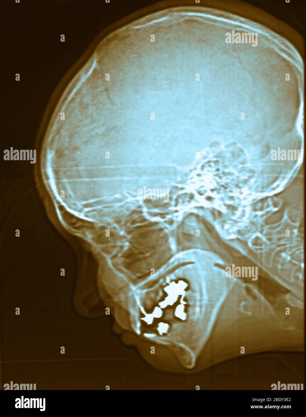 Normal skull x ray hi-res stock photography and images - Alamy