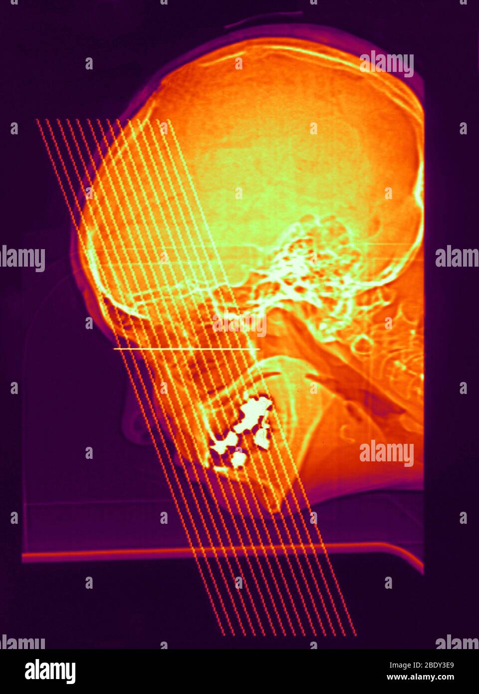 Normal X-ray of Sinuses Stock Photo - Alamy