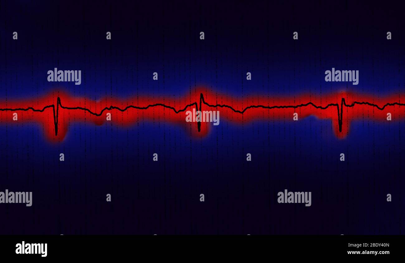Normal ecg hi-res stock photography and images - Alamy