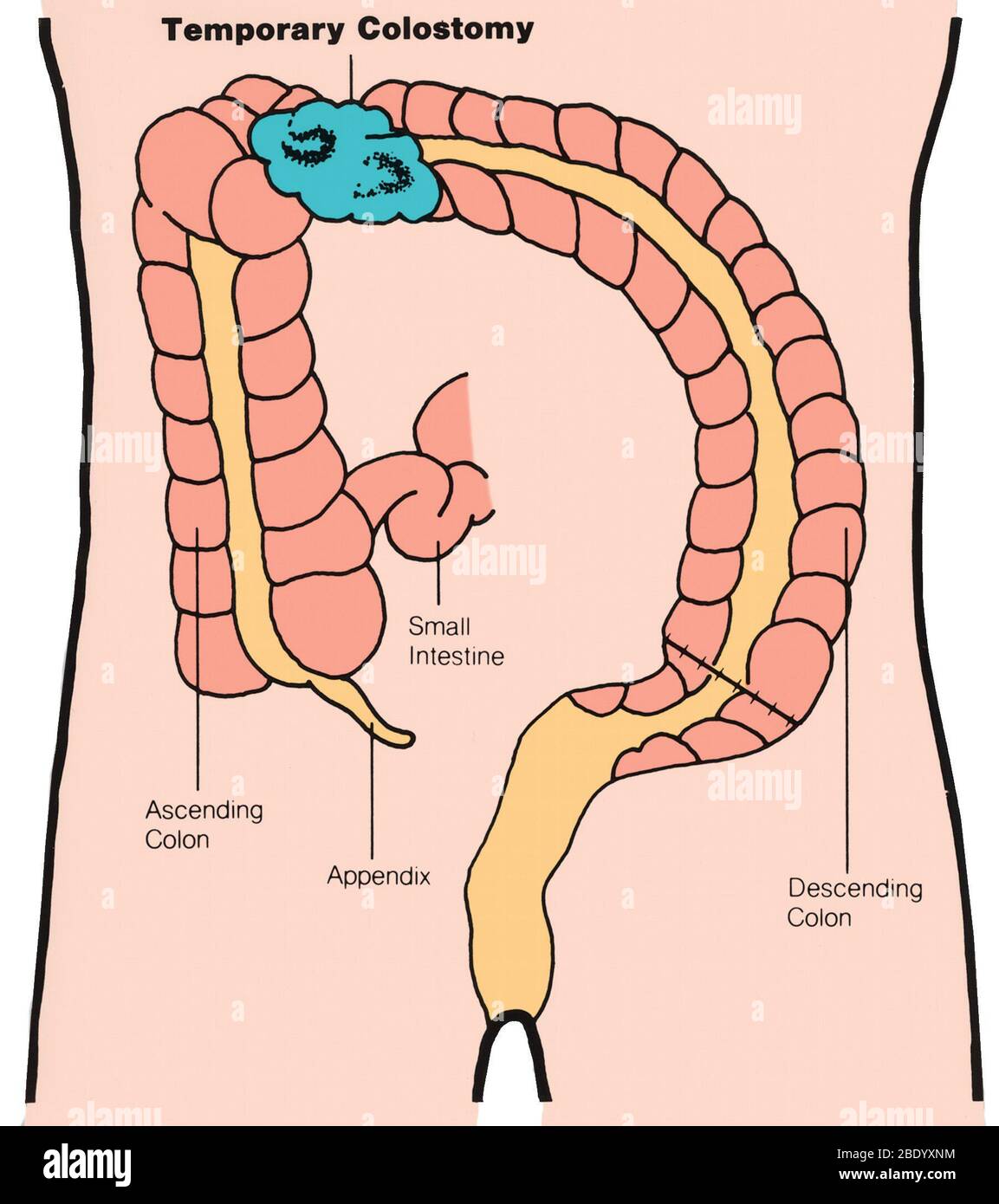 Abnormal Colon High Resolution Stock Photography and Images - Alamy