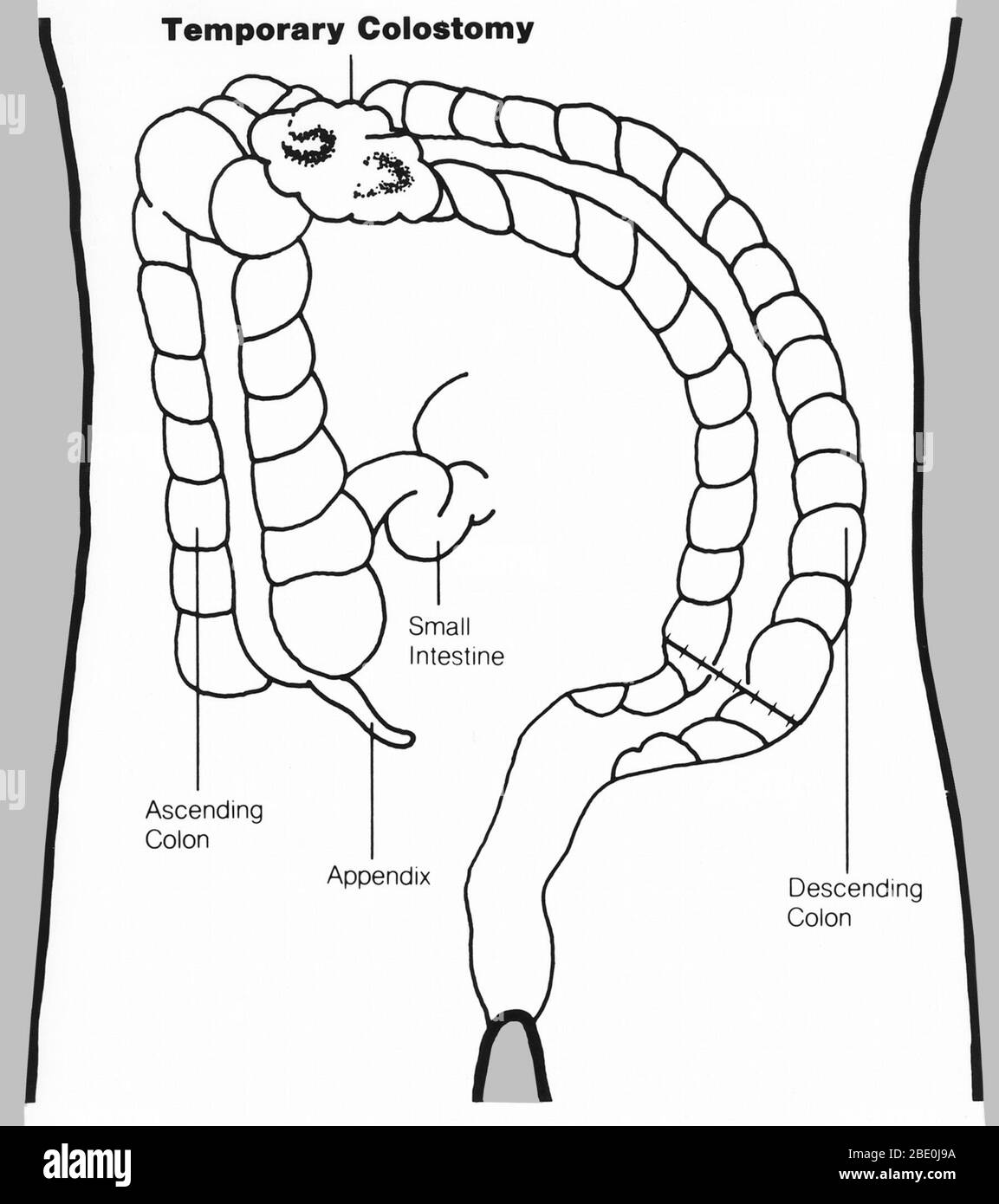 Colostomy procedure Black and White Stock Photos & Images - Alamy