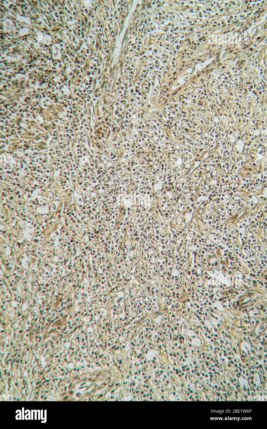 Actinomyces disease under the microscope 100x Stock Photo - Alamy