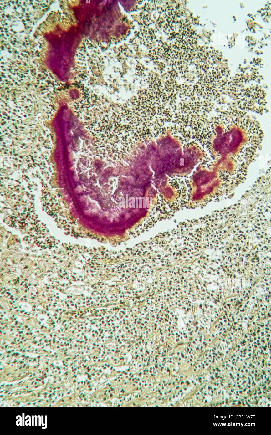 Actinomyces disease under the microscope 100x Stock Photo - Alamy