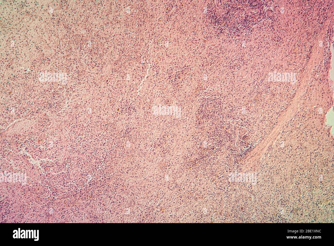 Scars in the heart muscle tissue 100x Stock Photo - Alamy