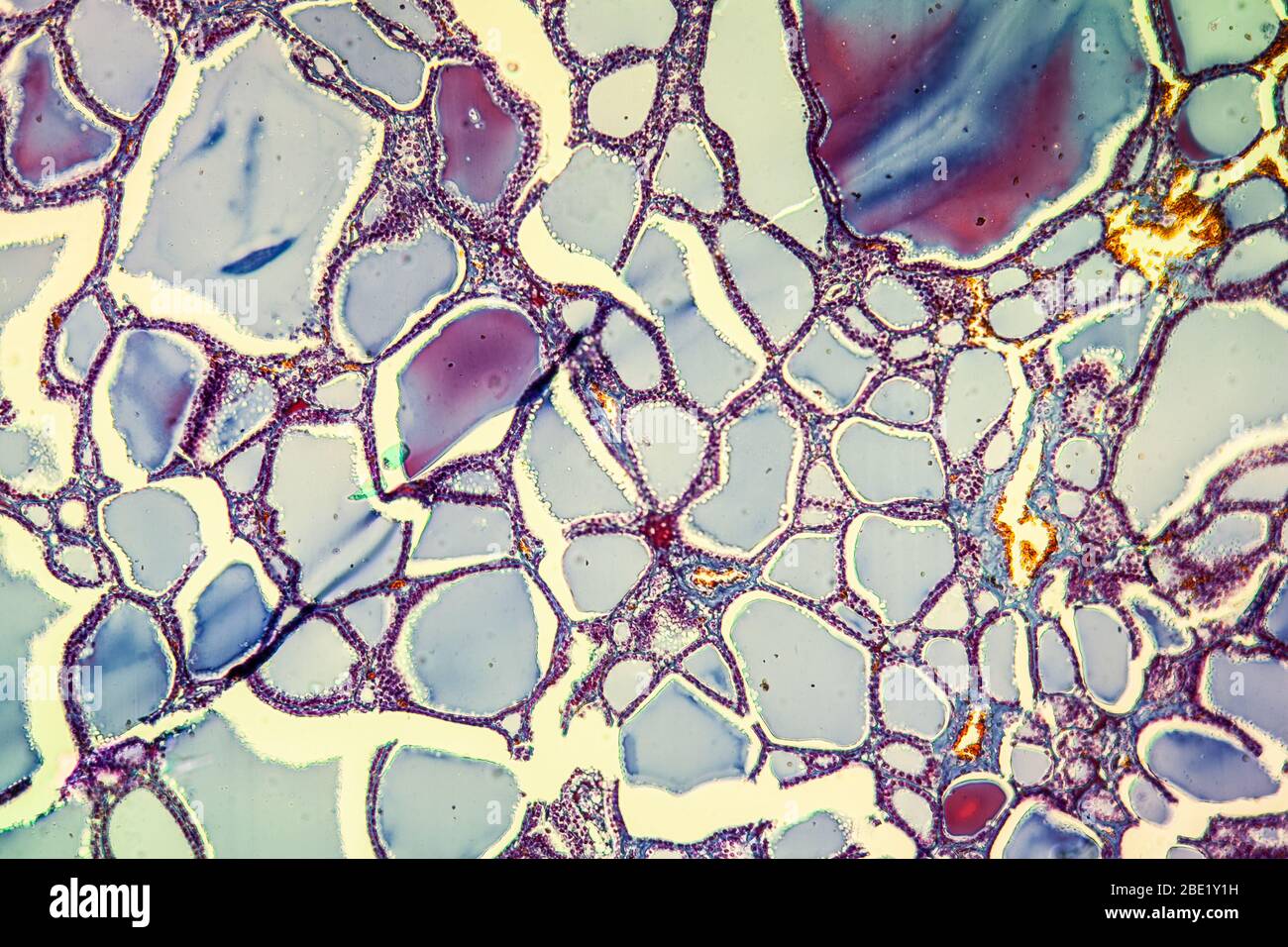 Thyroid Goiter High Resolution Stock Photography and Images - Alamy