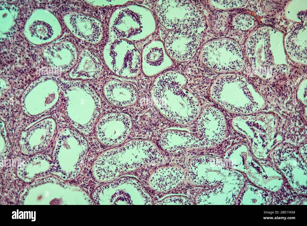 Inguinal testicles gonadically diseased tissue 100x Stock Photo - Alamy