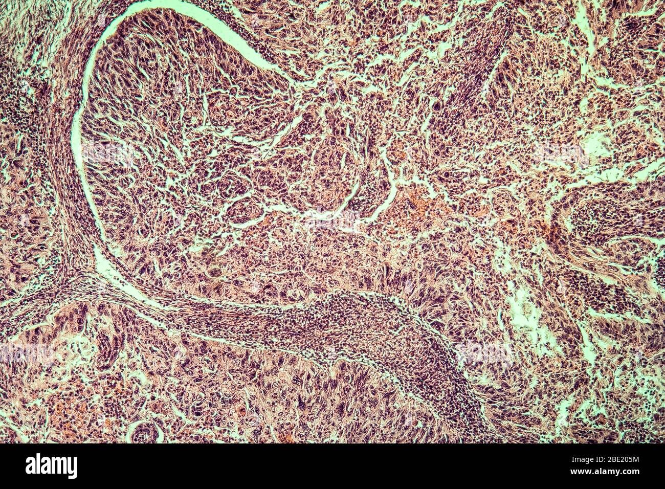 Uterine cancer diseased tissue 100x Stock Photo - Alamy
