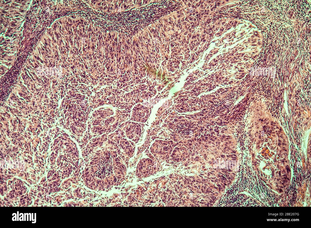 Uterine cancer diseased tissue 100x Stock Photo - Alamy
