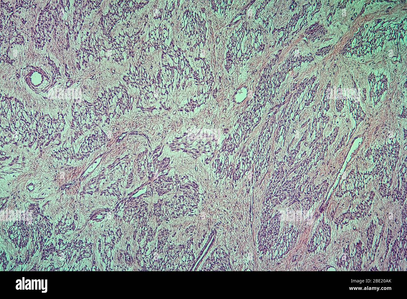 Fibromyoma of the uterus diseased tissue 100x Stock Photo - Alamy