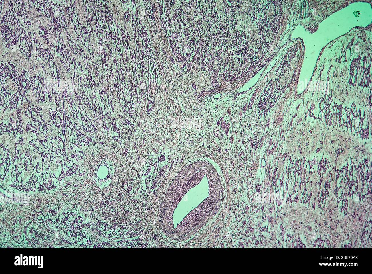 Fibromyoma of the uterus diseased tissue 100x Stock Photo - Alamy
