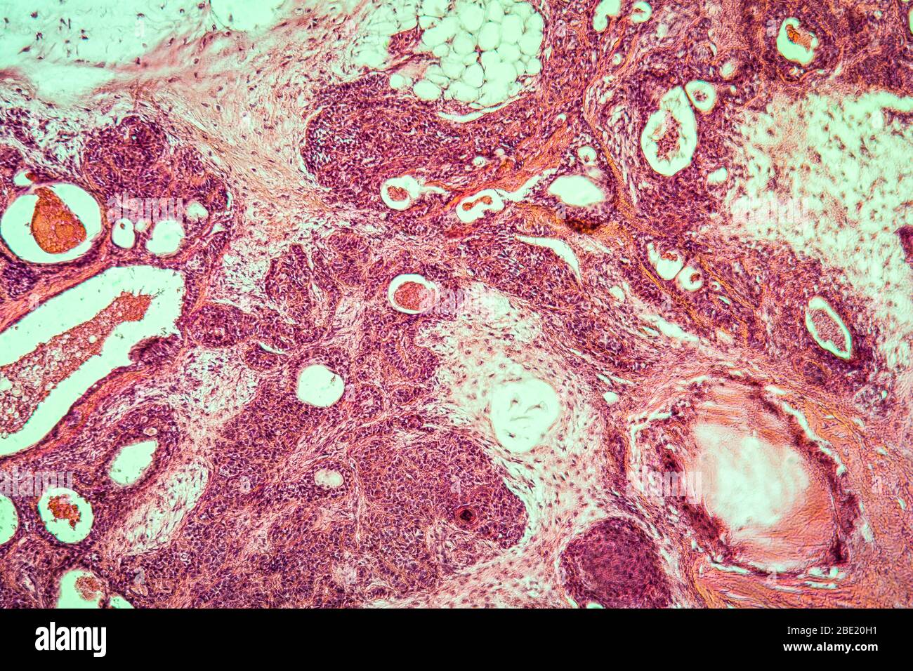 Cancer swollen Parotis diseased tissue 100x Stock Photo - Alamy