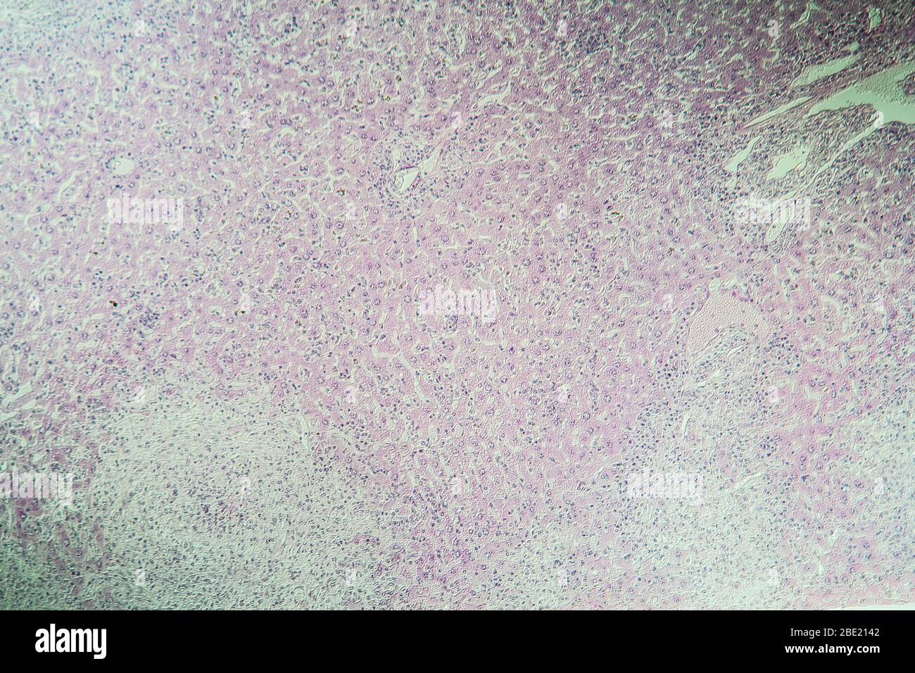 Tissue with schistosomiasis sick tissue 100x Stock Photo - Alamy