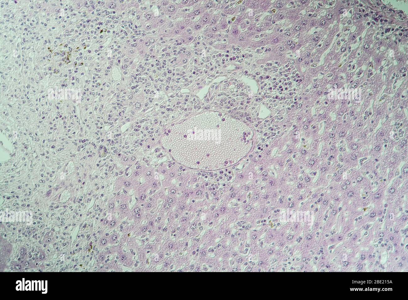 Tissue with schistosomiasis sick tissue 100x Stock Photo - Alamy