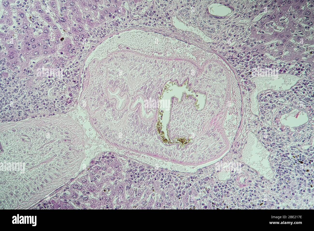 Tissue with schistosomiasis sick tissue 100x Stock Photo - Alamy