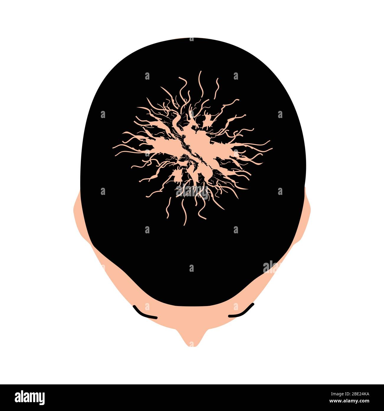 Alopecia hair. Baldness of hair on the head. Androgenic alopecia ...