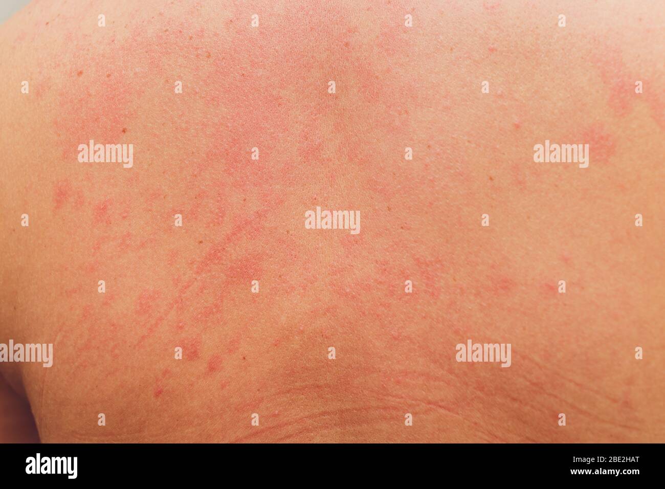 allergic rash on the body of the patient Stock Photo - Alamy