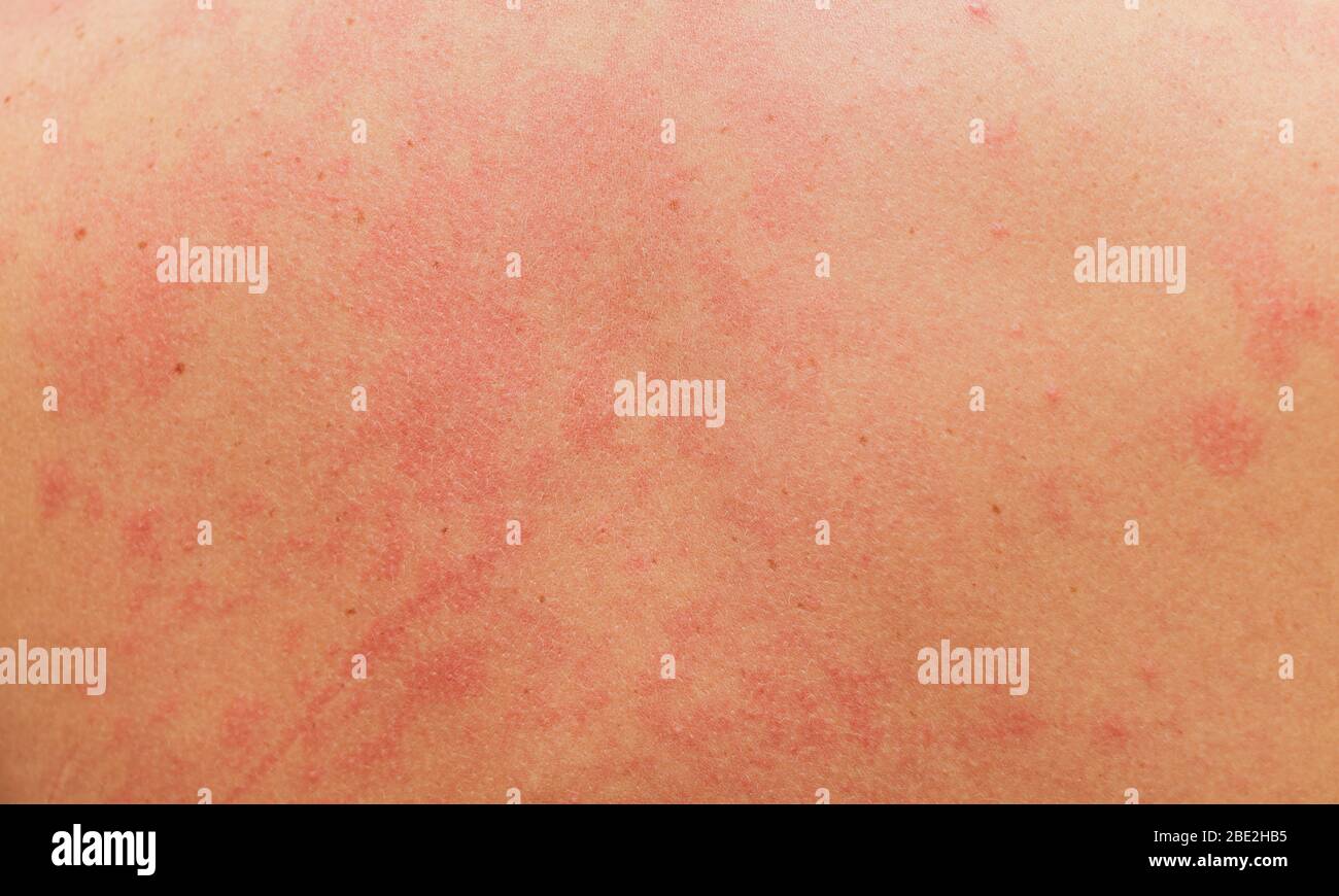 allergic rash on the body of the patient Stock Photo - Alamy