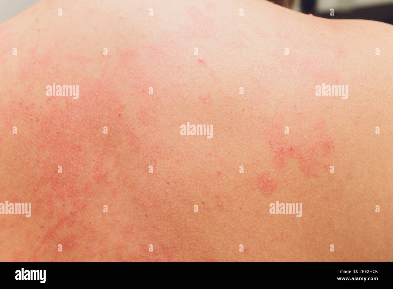 allergic rash on the body of the patient Stock Photo - Alamy