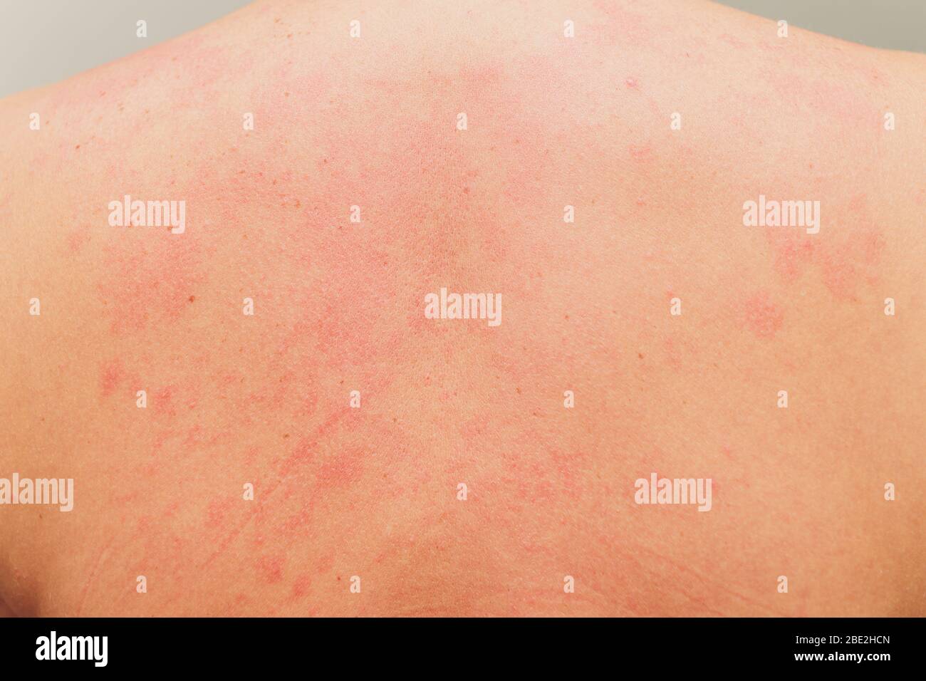 allergic rash on the body of the patient Stock Photo - Alamy