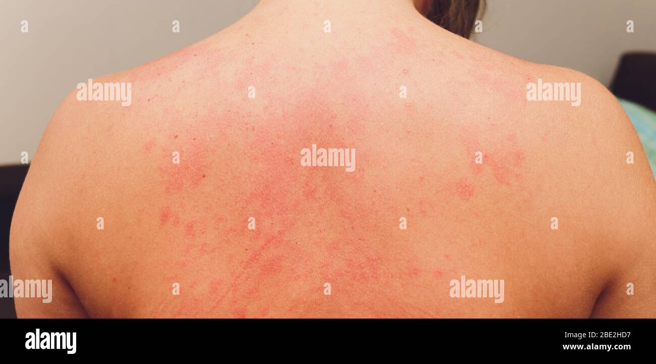 allergic rash on the body of the patient Stock Photo - Alamy