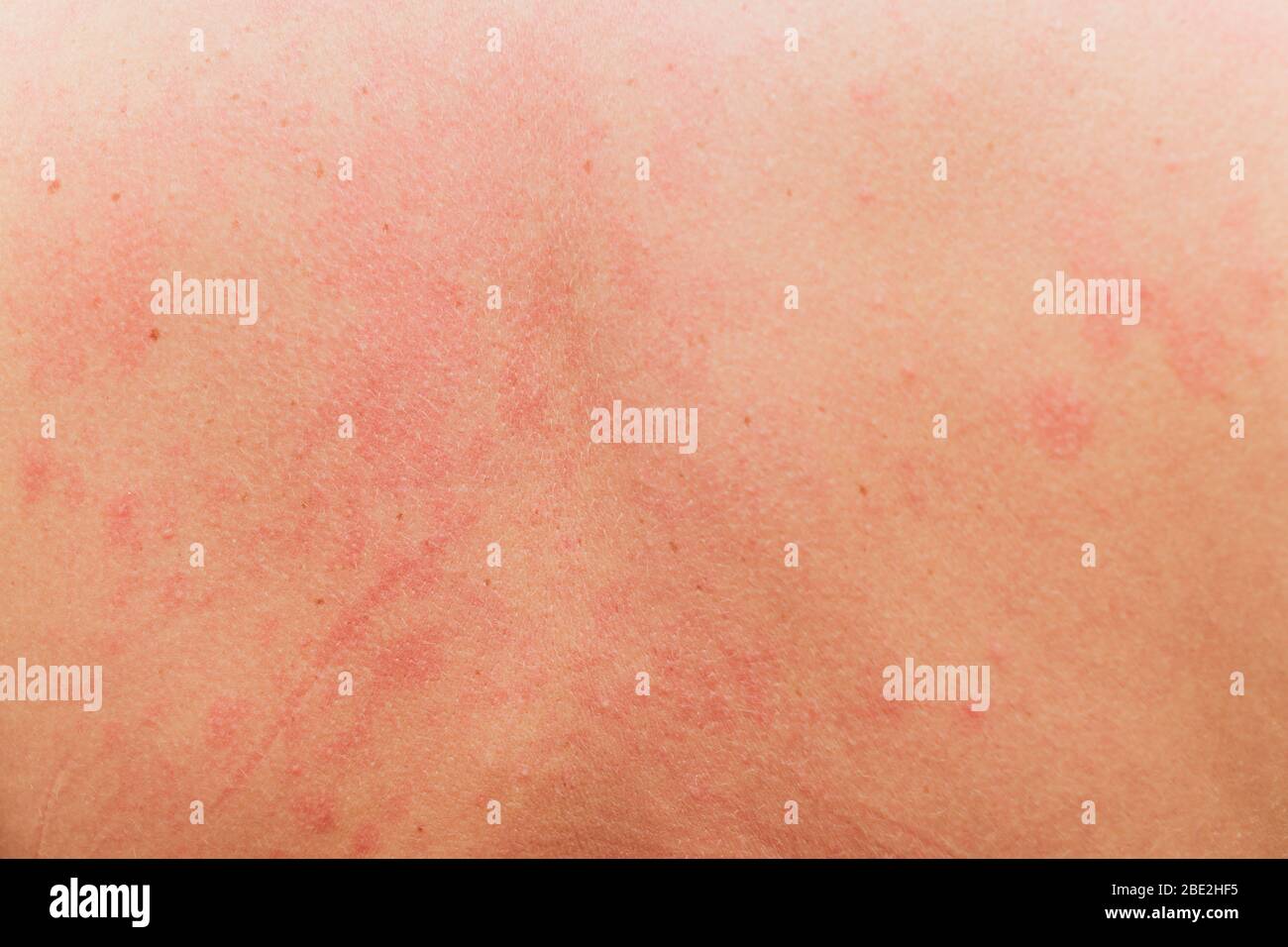 allergic rash on the body of the patient Stock Photo - Alamy