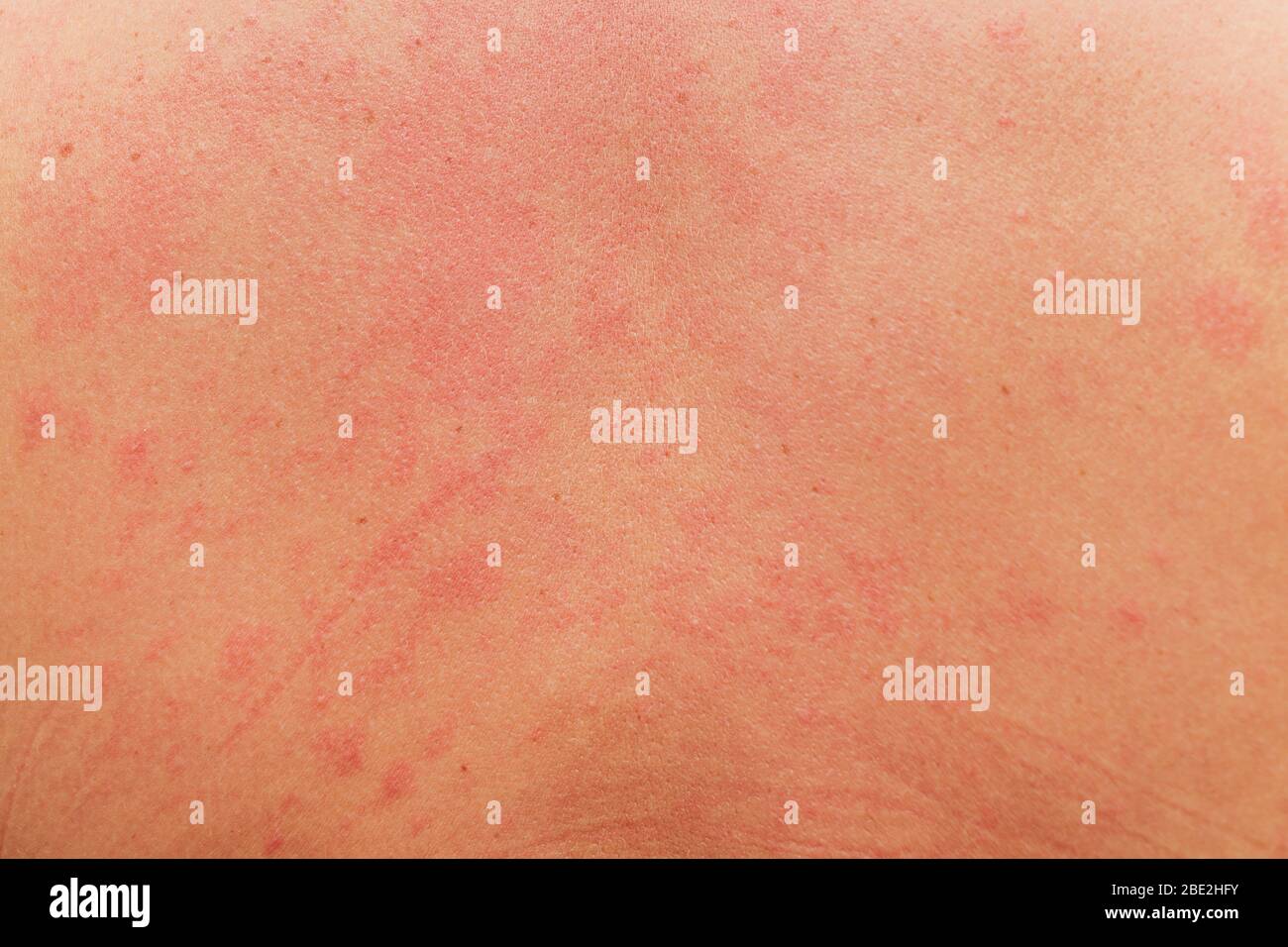 allergic rash on the body of the patient Stock Photo - Alamy