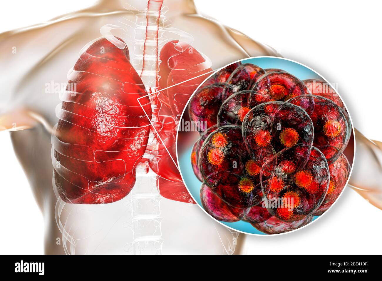Coronavirus pneumonia. Conceptual computer illustration showing ...