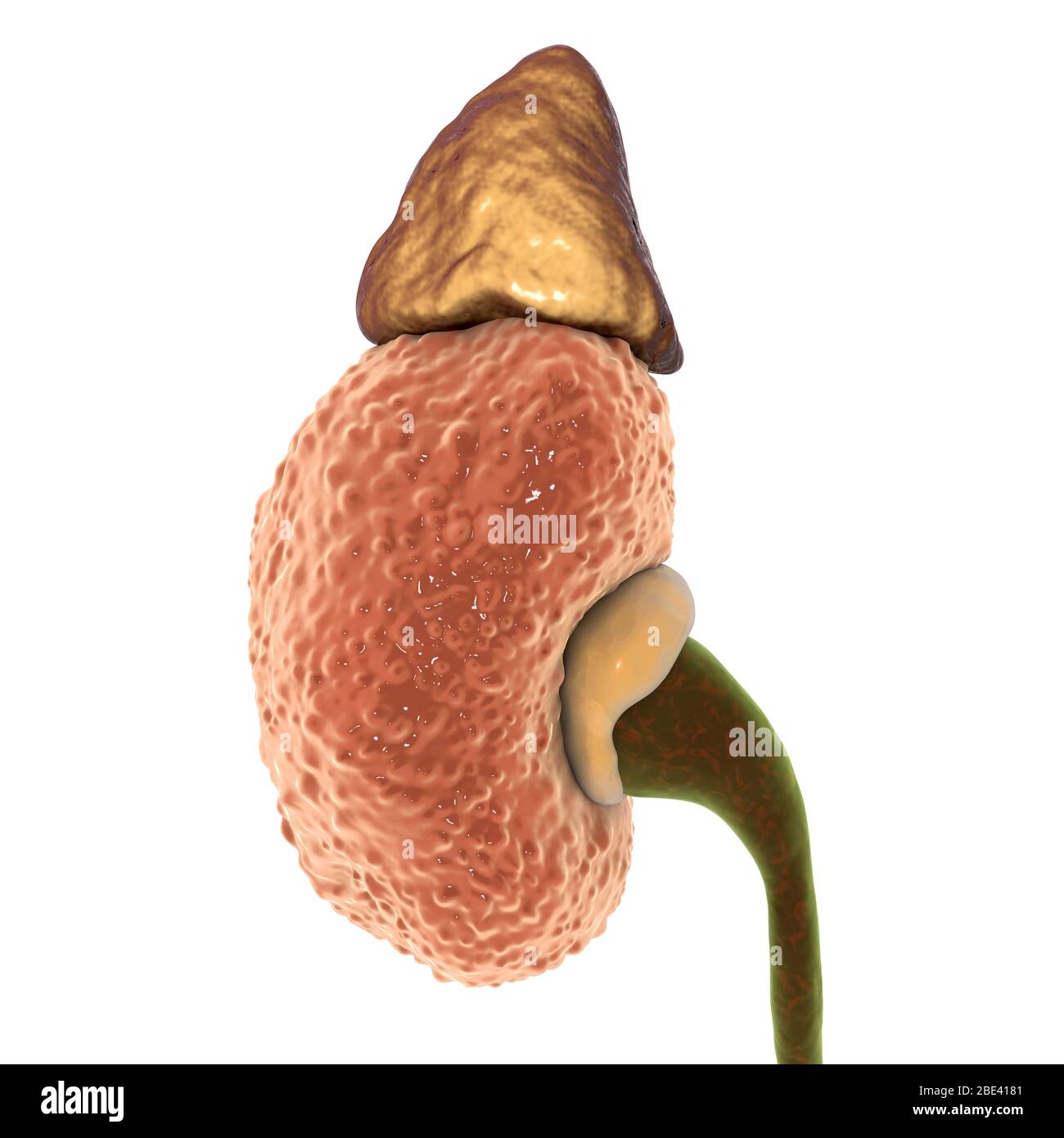 Chronic kidney disease. Computer illustration showing the gross anatomy ...