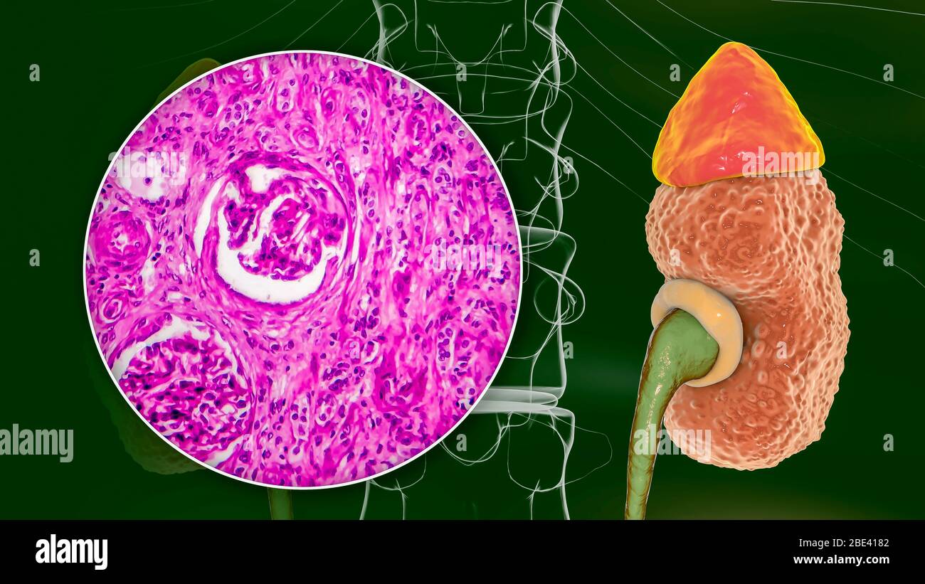 Chronic kidney disease, computer illustration and light micrograph. The ...