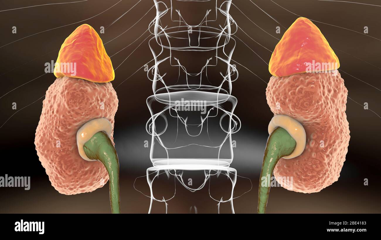 Chronic kidney disease. Computer illustration showing the gross anatomy ...