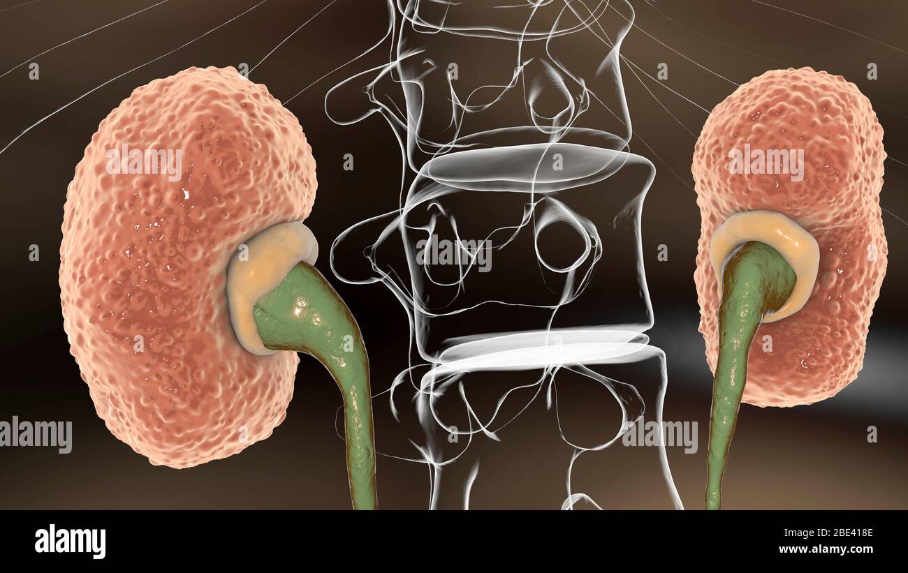 Chronic kidney disease. Computer illustration showing the gross anatomy ...