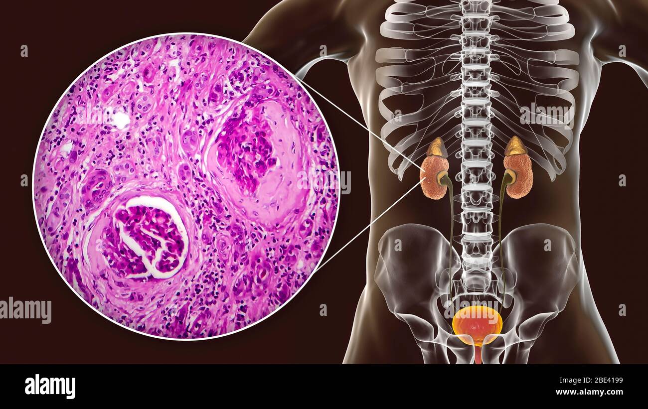Chronic kidney disease, computer illustration and light micrograph. The ...