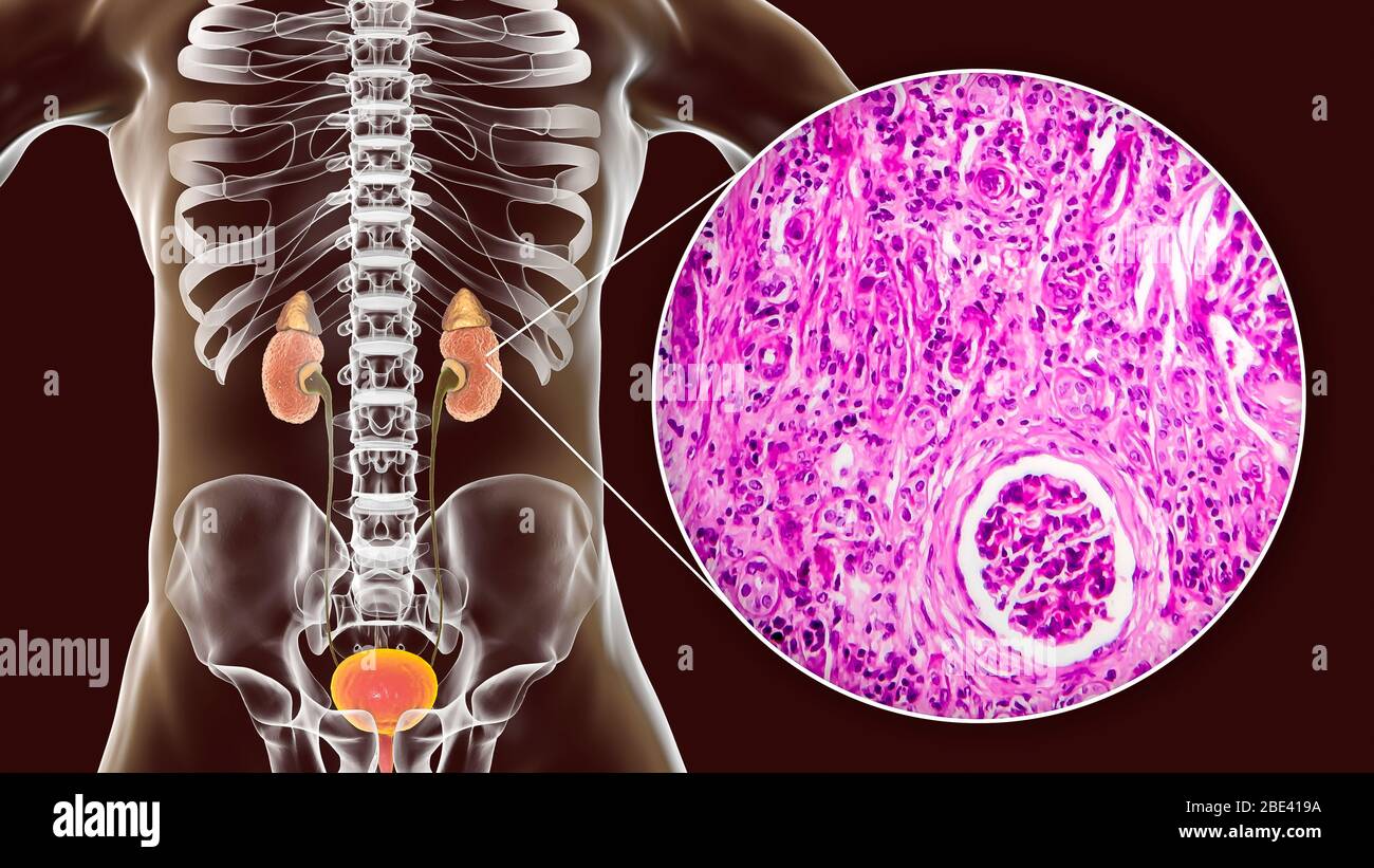 Chronic kidney disease, computer illustration and light micrograph. The ...
