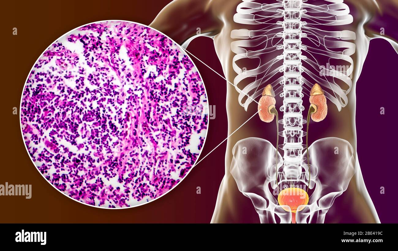 Chronic kidney disease, computer illustration and light micrograph. The ...