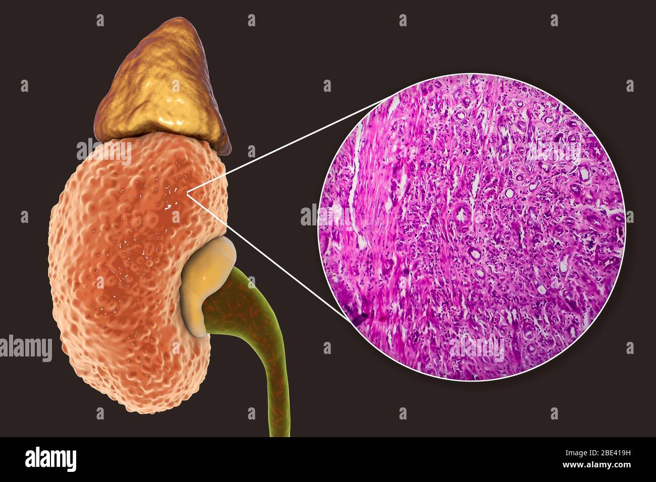 Chronic kidney disease, computer illustration and light micrograph. The ...