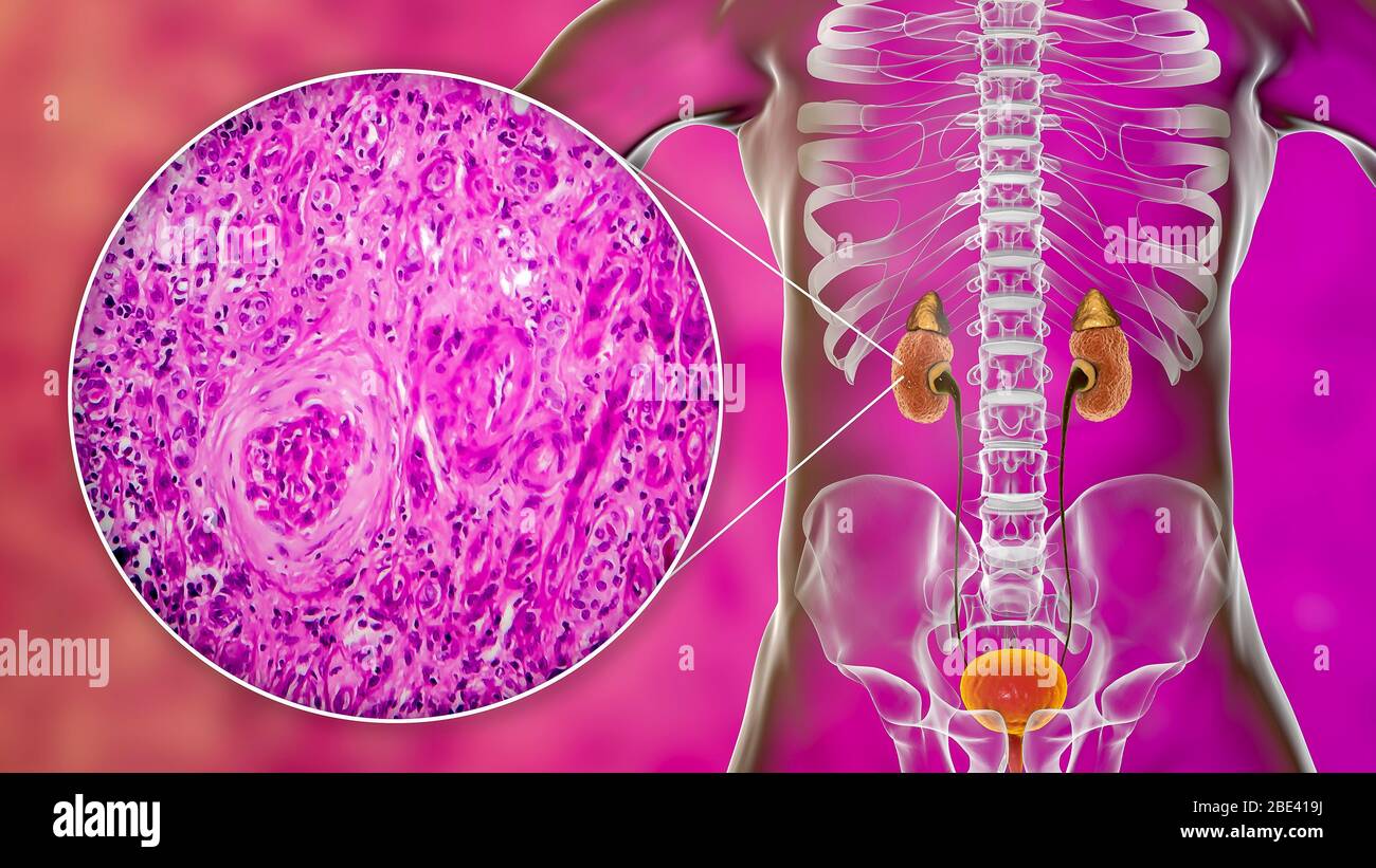 Chronic kidney disease, computer illustration and light micrograph. The ...
