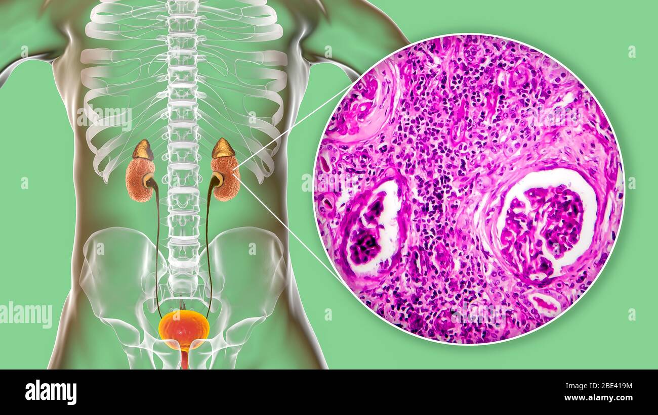 Chronic kidney disease, computer illustration and light micrograph. The ...