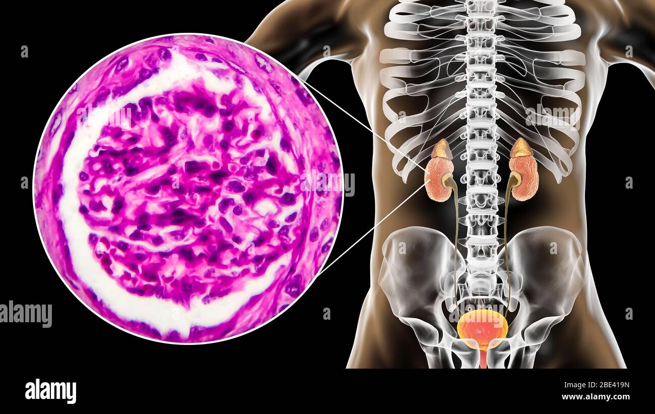 Chronic kidney disease, computer illustration and light micrograph. The ...