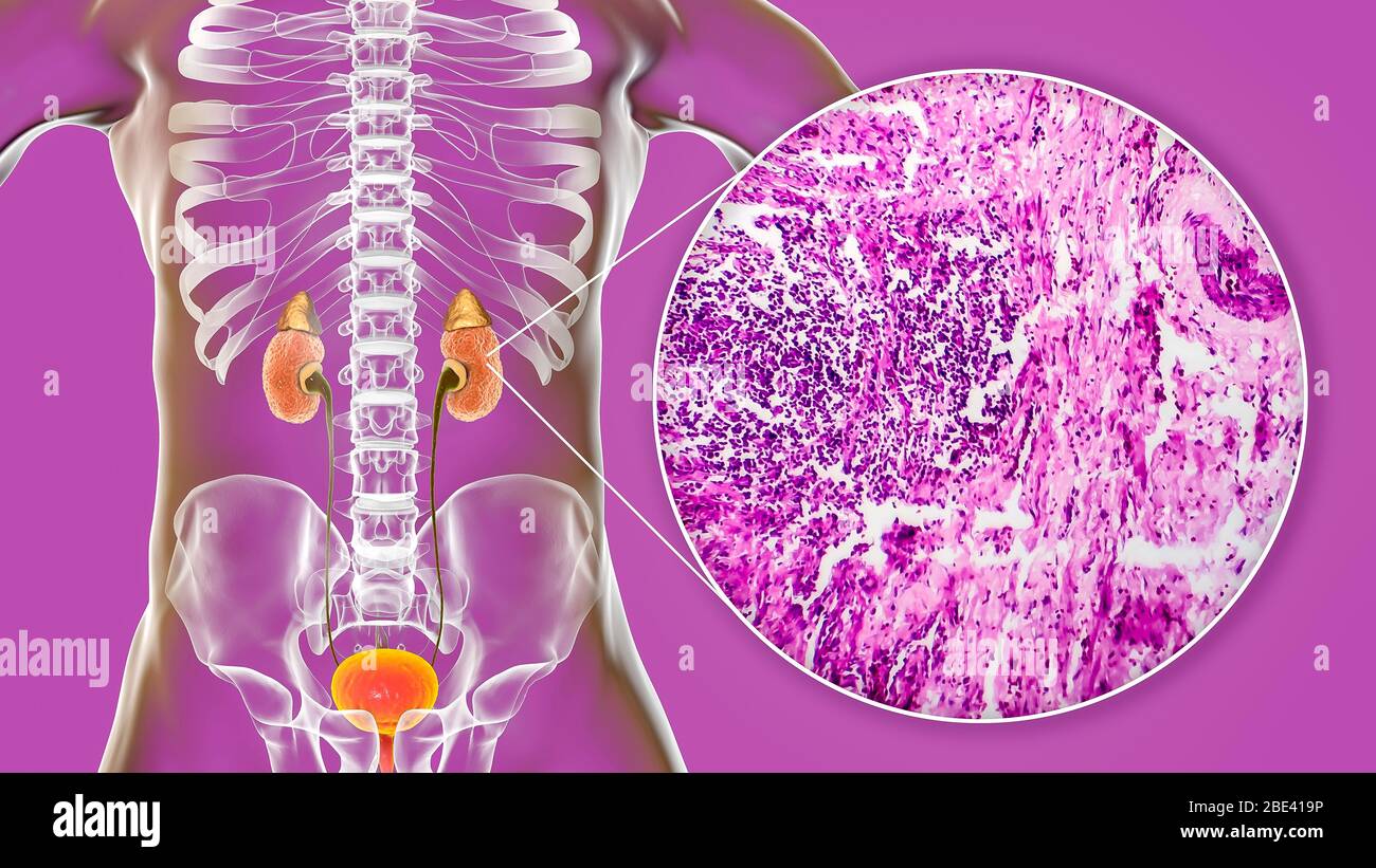 Chronic kidney disease, computer illustration and light micrograph. The ...