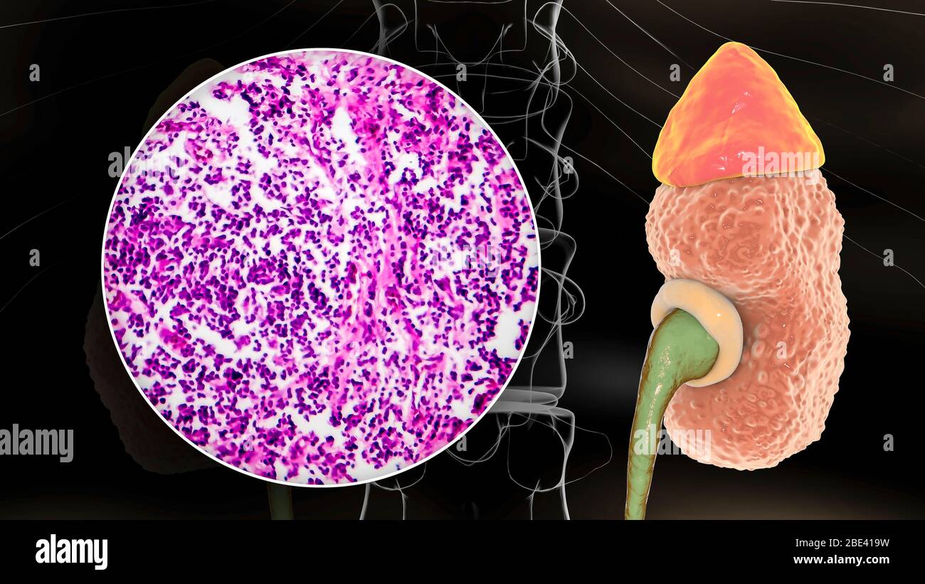 Chronic kidney disease, computer illustration and light micrograph. The ...