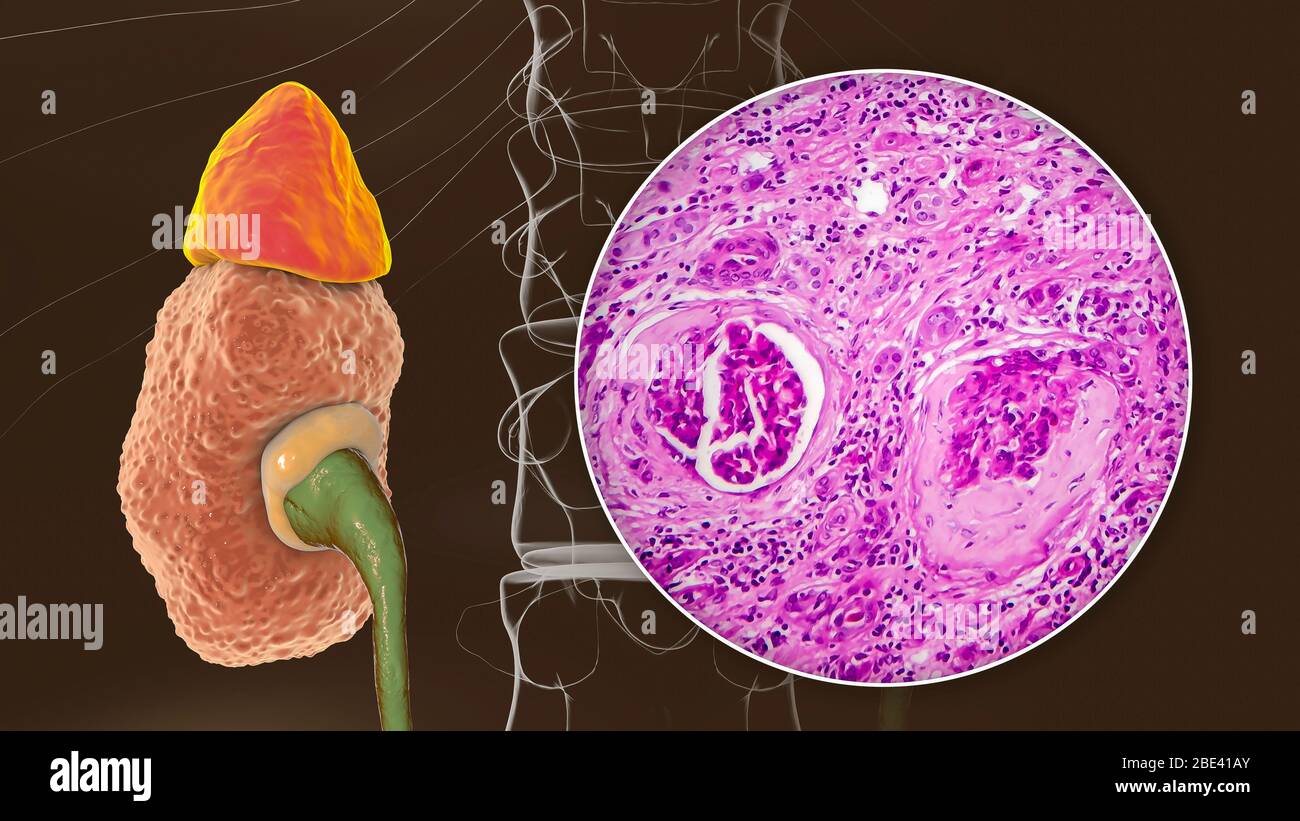 Chronic kidney disease, computer illustration and light micrograph. The ...