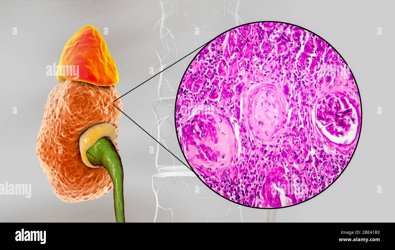 Chronic kidney disease, computer illustration and light micrograph. The ...