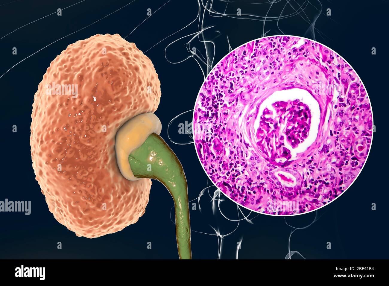 Chronic kidney disease, computer illustration and light micrograph. The ...