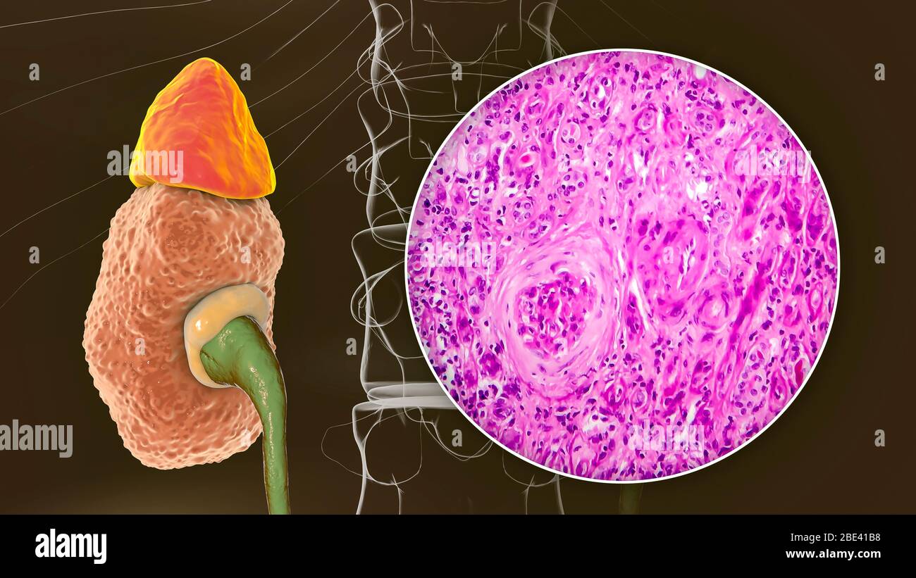 Chronic kidney disease, computer illustration and light micrograph. The ...