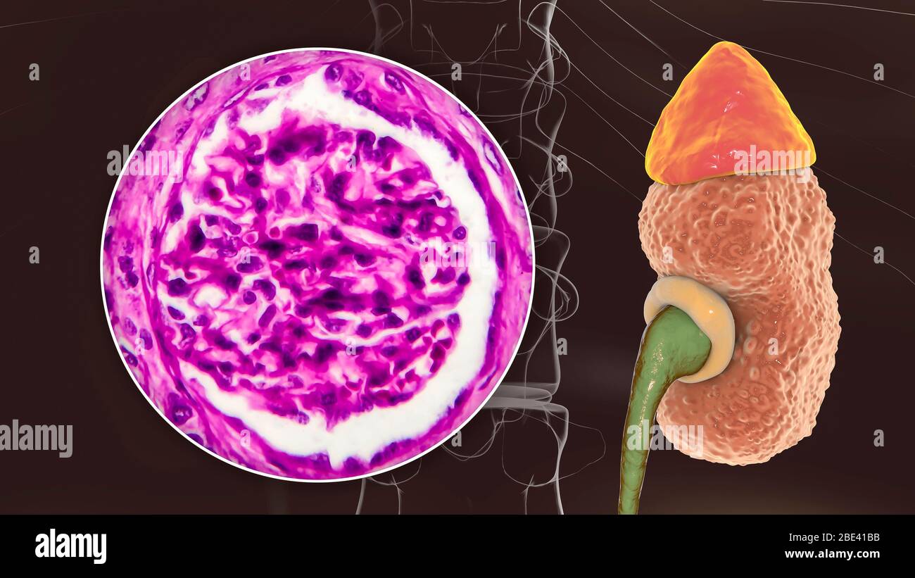 Chronic kidney disease, computer illustration and light micrograph. The ...