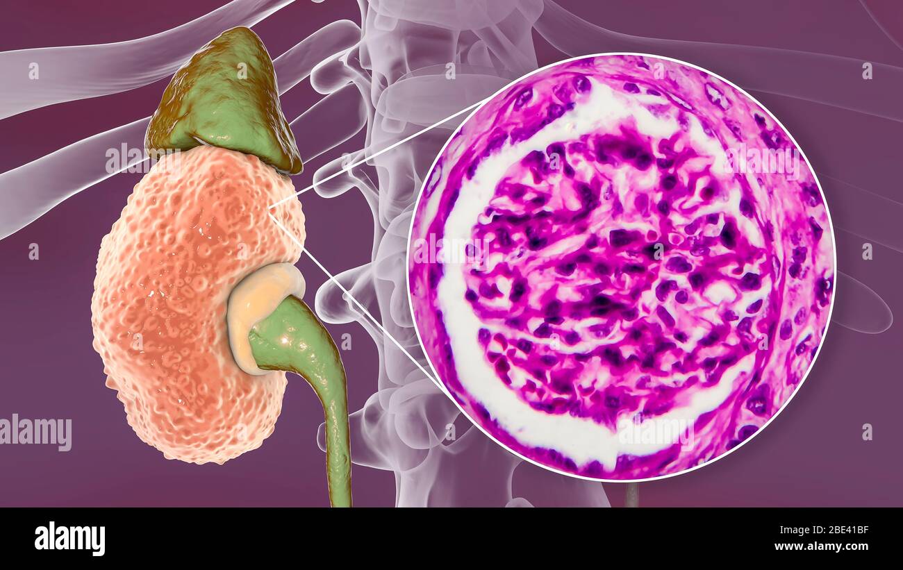 Chronic kidney disease, computer illustration and light micrograph. The ...