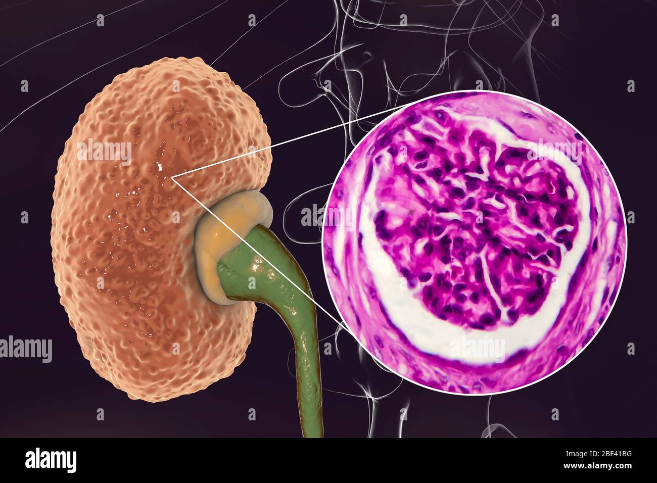 Chronic kidney disease, computer illustration and light micrograph. The ...