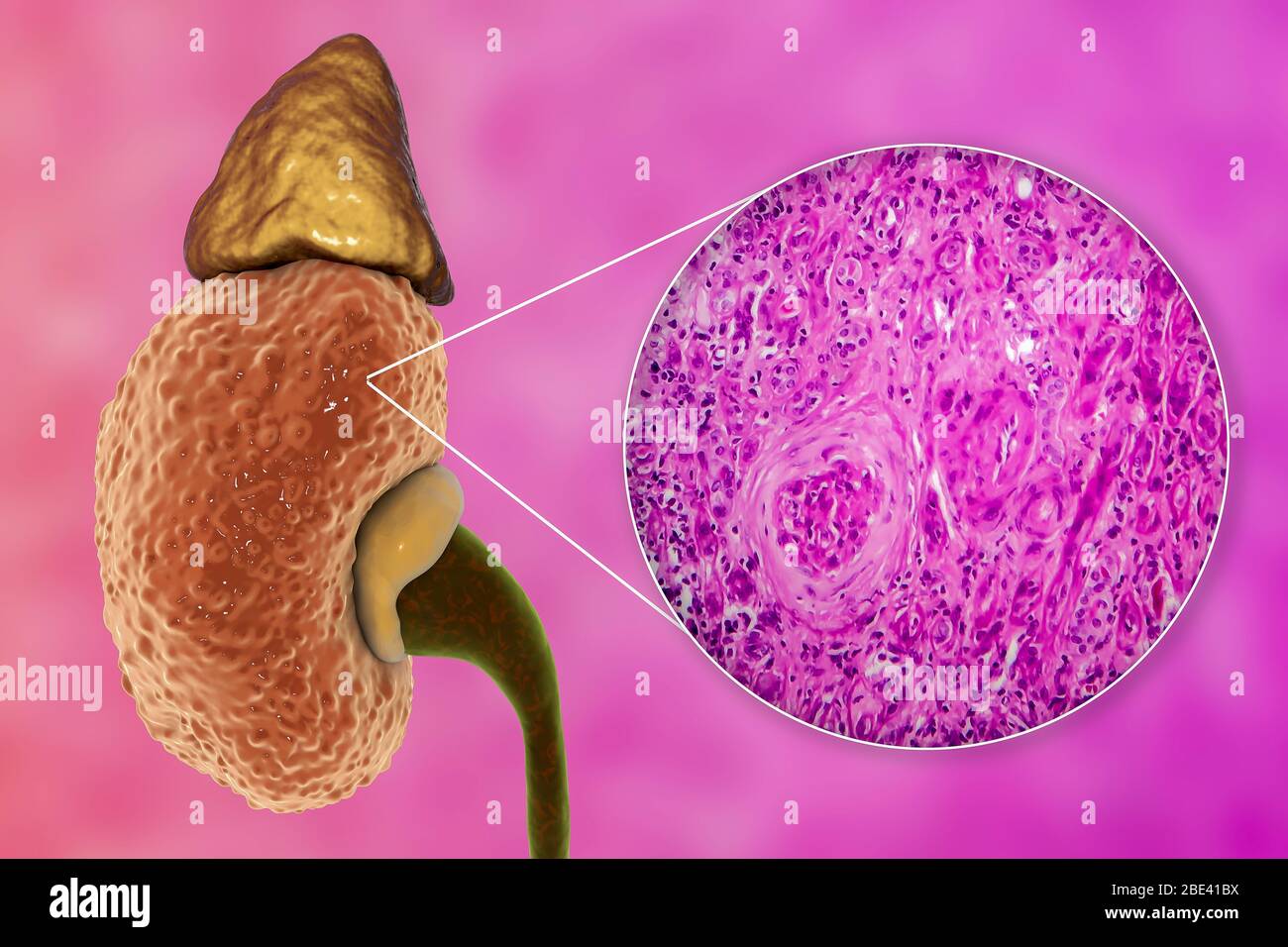 Chronic kidney disease, computer illustration and light micrograph. The ...